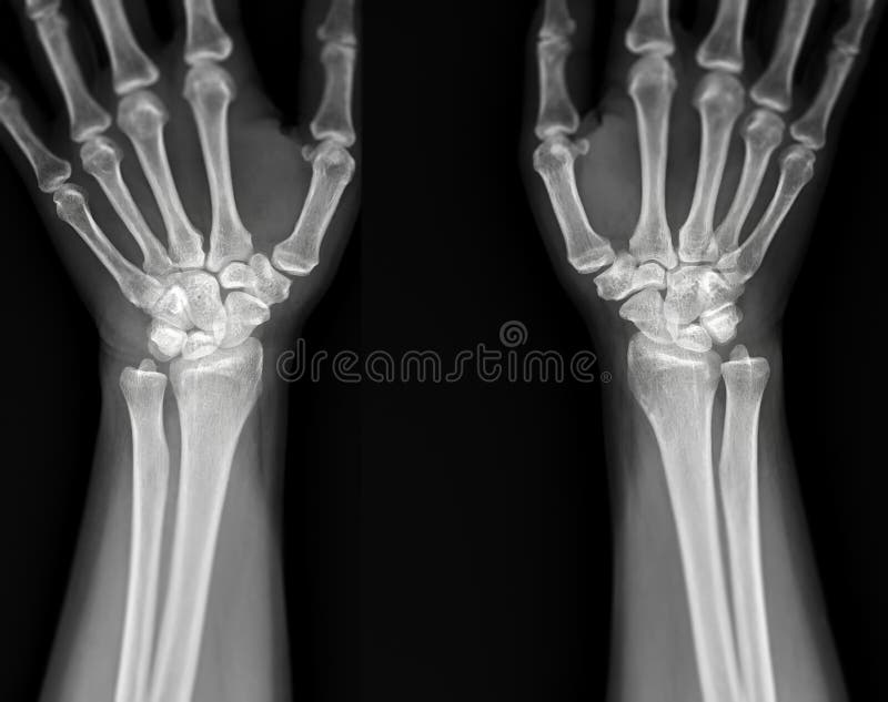 X-ray Image of Wrist Joint for Diagnosis Rheumatoid Arthritis Stock ...