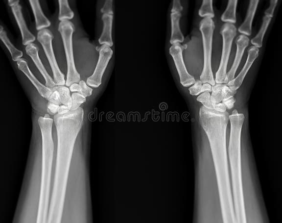 X-ray Image of Wrist Joint Front View of Normal Wrist Joint Stock Image ...