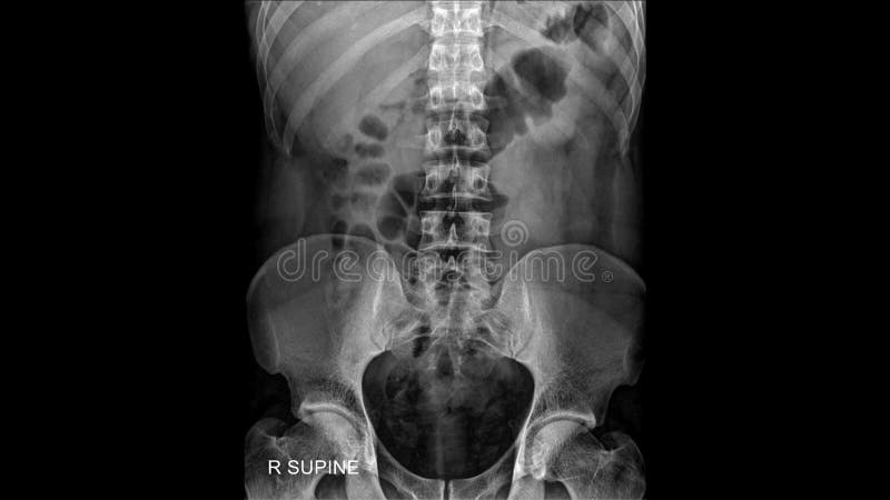 X-ray Imaging of Kidneys, Ureters, and Bladder Video Stock Footage ...