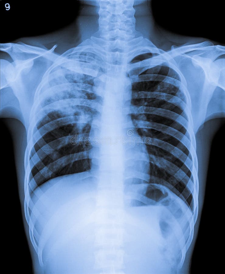 X Ray of infected chest. stock photo. Image of maker - 94628664