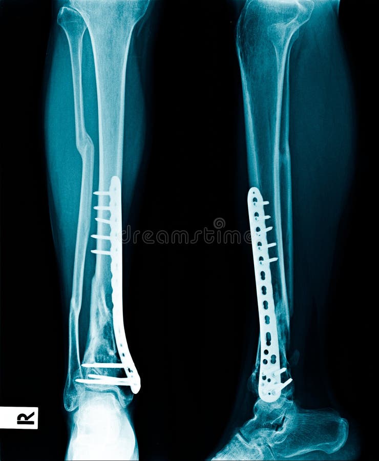 Distal Tibia Fracture and Distal Fibular Fusion Stock Image - Image of ...