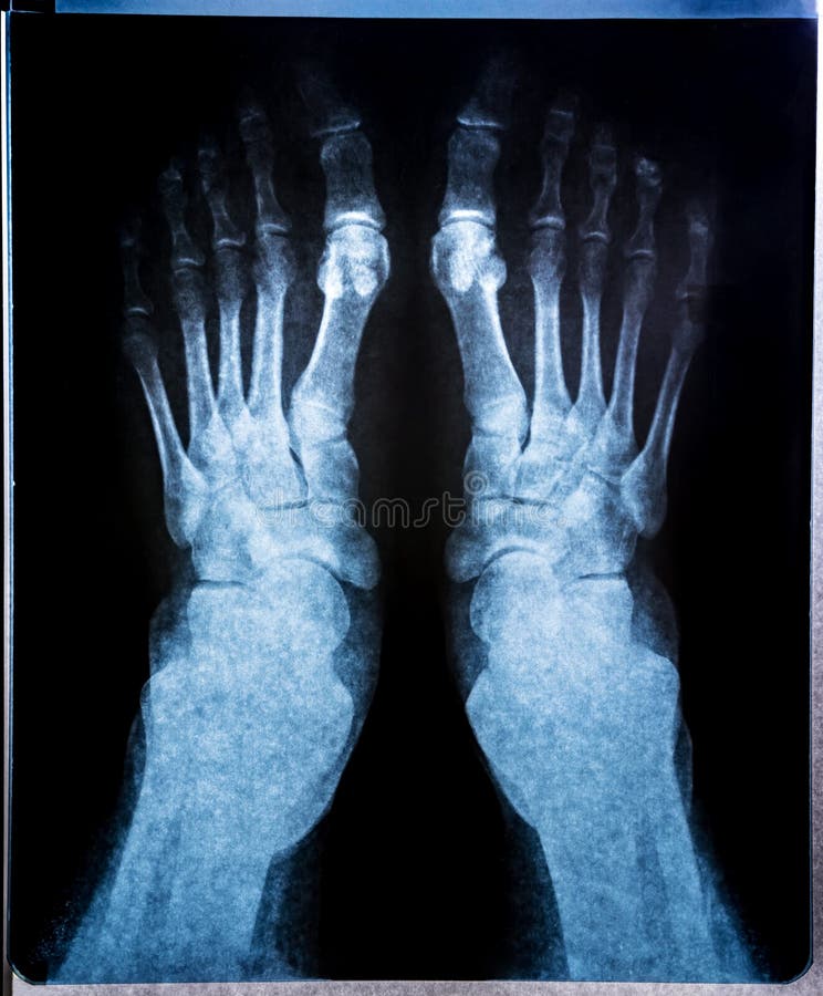 X-ray Image of Hip Joint, Lateral View. Stock Photo - Image of ...