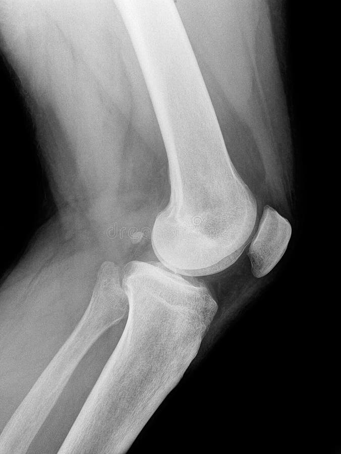X-ray of the knee stock photo. Image of broken, medical - 24677528