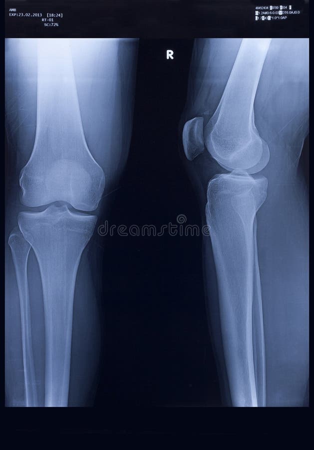 X-Ray, Knee stock photo. Image of left, cartilage, side - 33910614