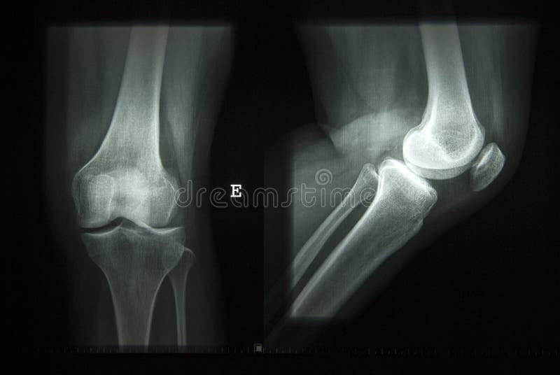 Normal Knee xray stock photo. Image of radiology, hospital - 14088732
