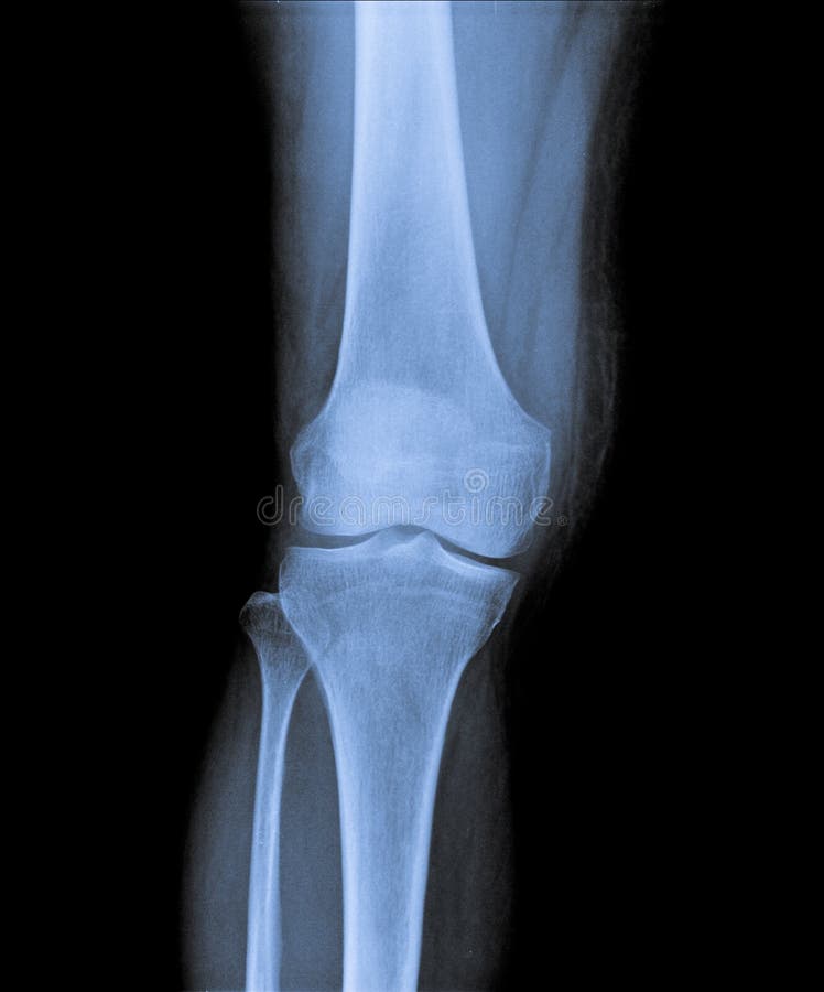 X Ray of Knee joint. stock image. Image of joint, imaging - 74660417