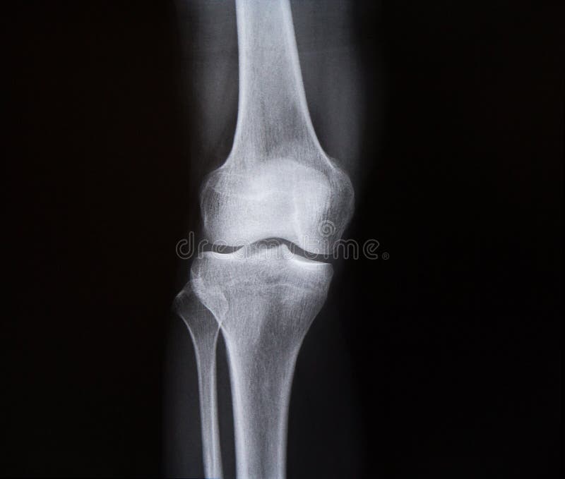 X-ray of the Knee Joint of the Leg Stock Photo - Image of education ...
