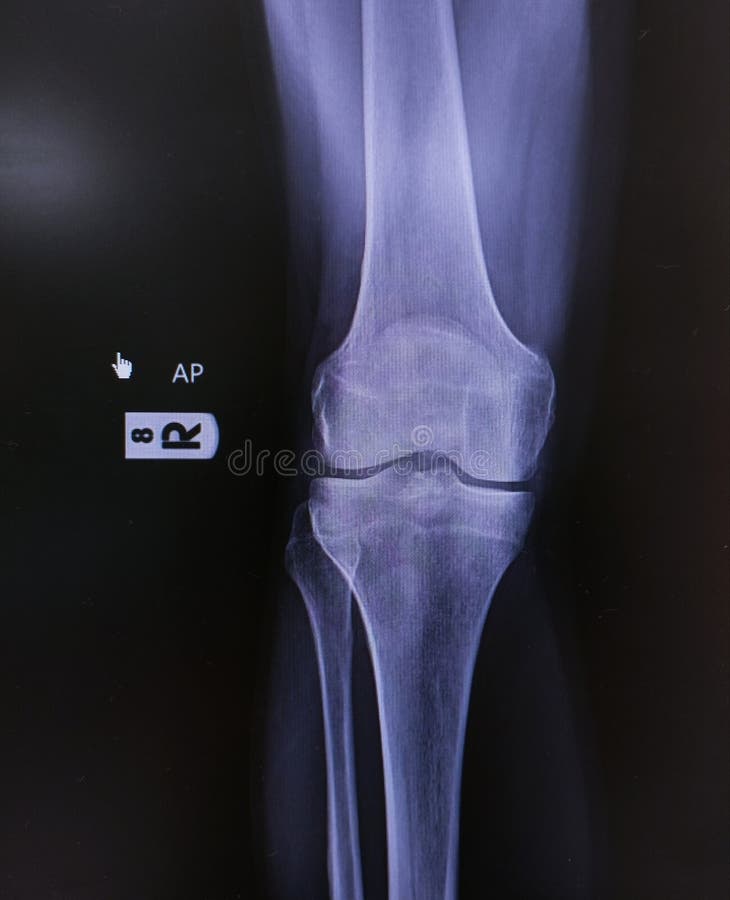 X-ray of Knee Joint Side View. Normal Joint and Space, Medical Image ...