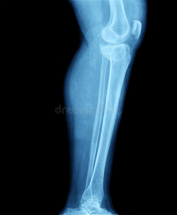X-ray of knee and leg stock image. Image of hospital - 47700185