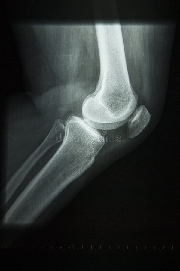 64 X Ray Normal Knee Photos - Free & Royalty-Free Stock Photos from ...