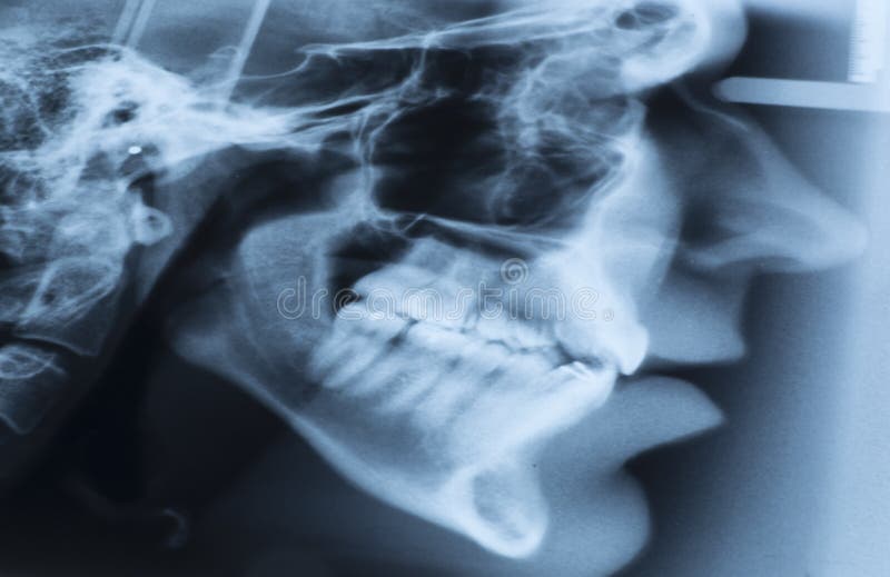 Cephalometric X-ray stock photo. Image of cephalometric - 6812250