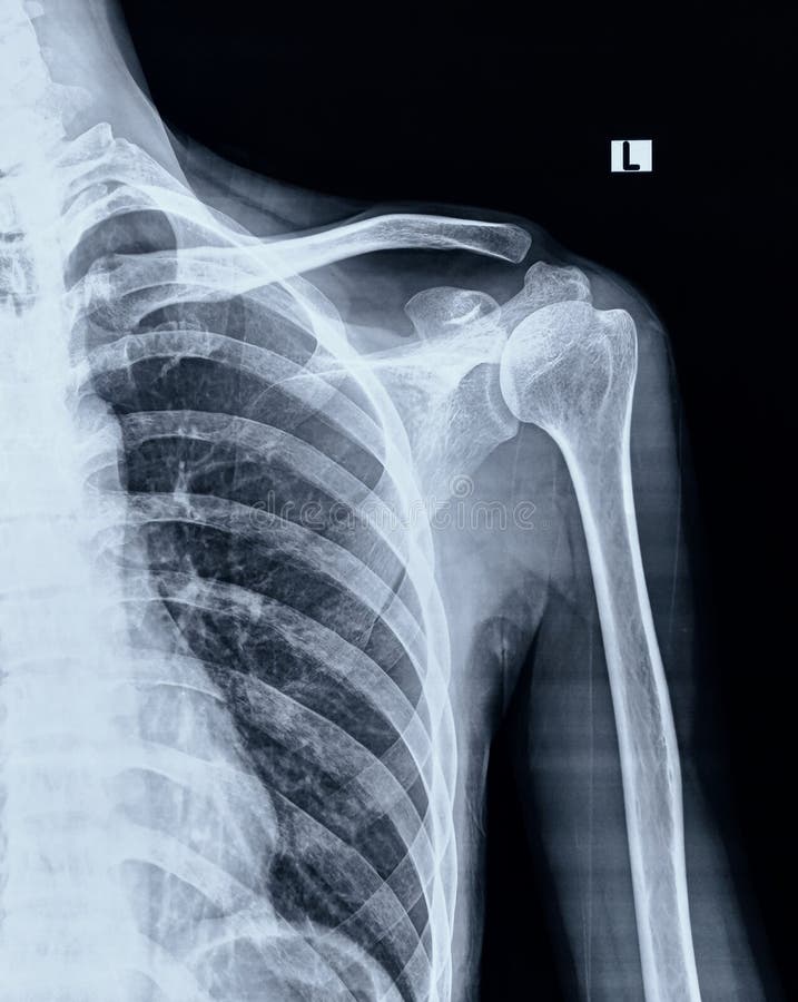 1,318 Shoulder Ray Stock Photos - Free & Royalty-Free Stock Photos from ...