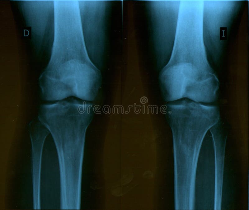 X-ray of the Leg of a Person Stock Photo - Image of health, injury ...