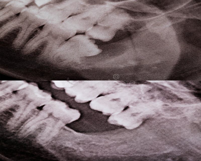 X-ray of the Lower Wisdom Tooth and after Wisdom Tooth Removal, Close ...