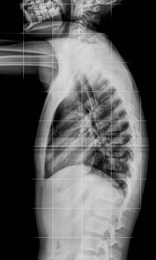 X-ray Lumbo-sacral Spine and Head Stock Image - Image of radiology ...