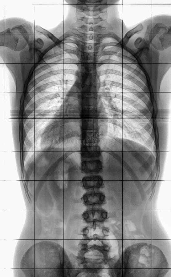 X-ray Lumbo-sacral Spine and Head Stock Image - Image of internal ...