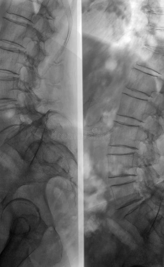 X-ray Lumbo-sacral Spine and Pelvis. Examination Scan Stock Image ...