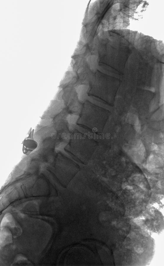 X-ray Lumbo-sacral Spine and Pelvis. Examination Scan Stock Photo ...