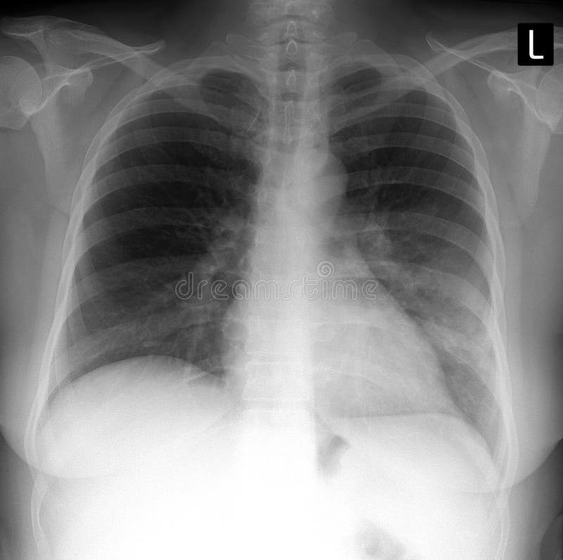 X-ray Lung. Showing a Large Infiltrate in the Left Lung. Pneumonia ...
