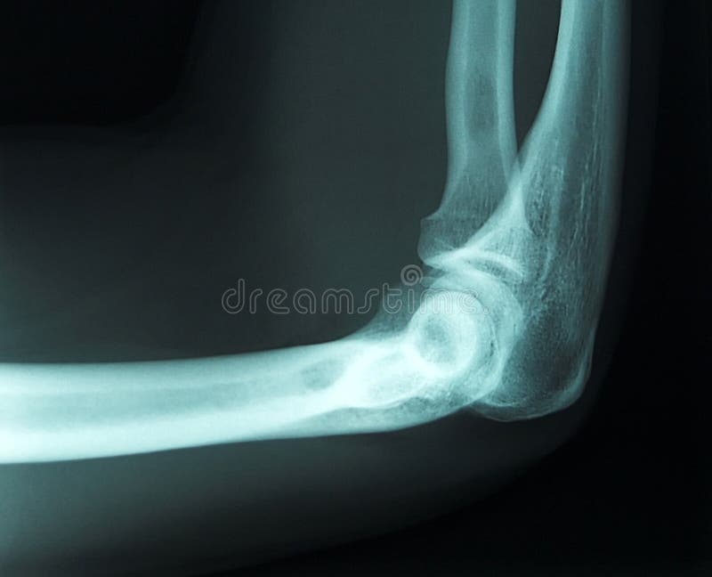 X-ray of a male arm stock image. Image of body, technology - 3747517