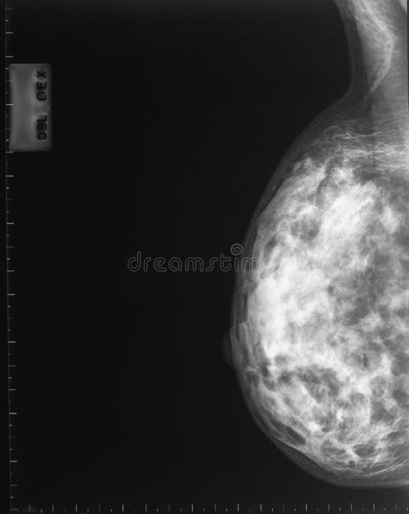 X-ray mammogram stock image. Image of control, checking - 12242953