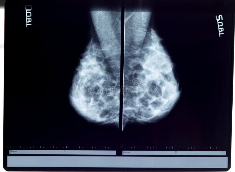 Mammogram stock photo. Image of clinical, examining, diagnostic - 19477220
