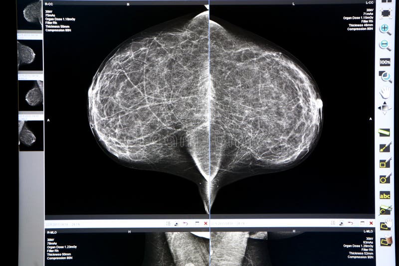 X-ray mammogram stock photo. Image of cancer, prevention - 41308776