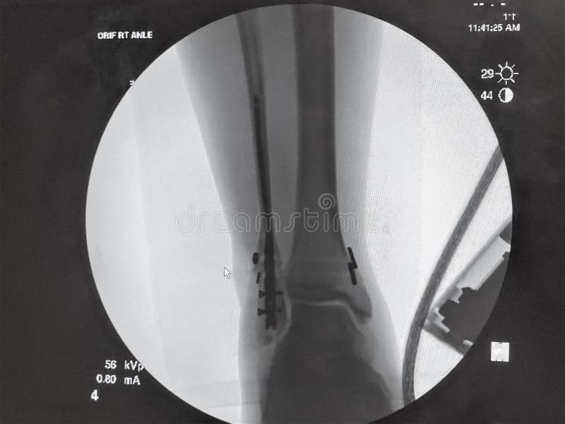 X-ray of Metal Implants through Broken Fibula Stock Image - Image of ...