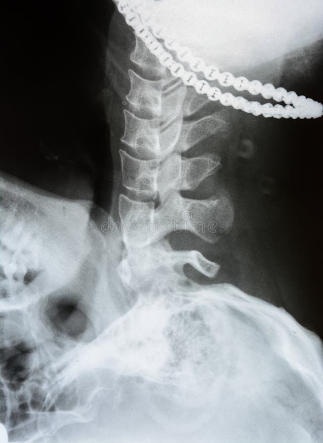 X-ray of the neck stock image. Image of person, patient - 42382579