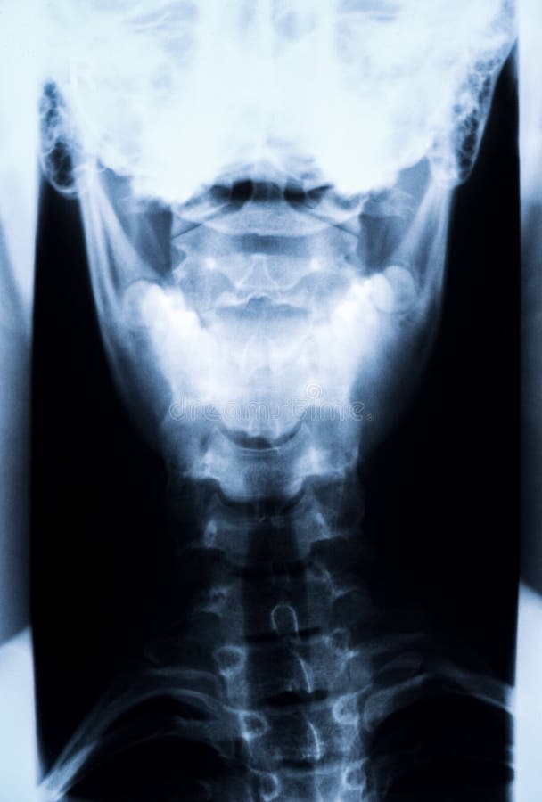 Xray Film of a Skull of a Patient with Paranasal Sinus with Acute Right ...