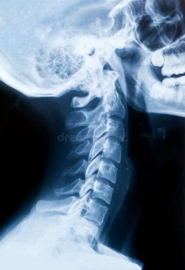X-ray of the Neck and Skull - Side View Stock Image - Image of body ...
