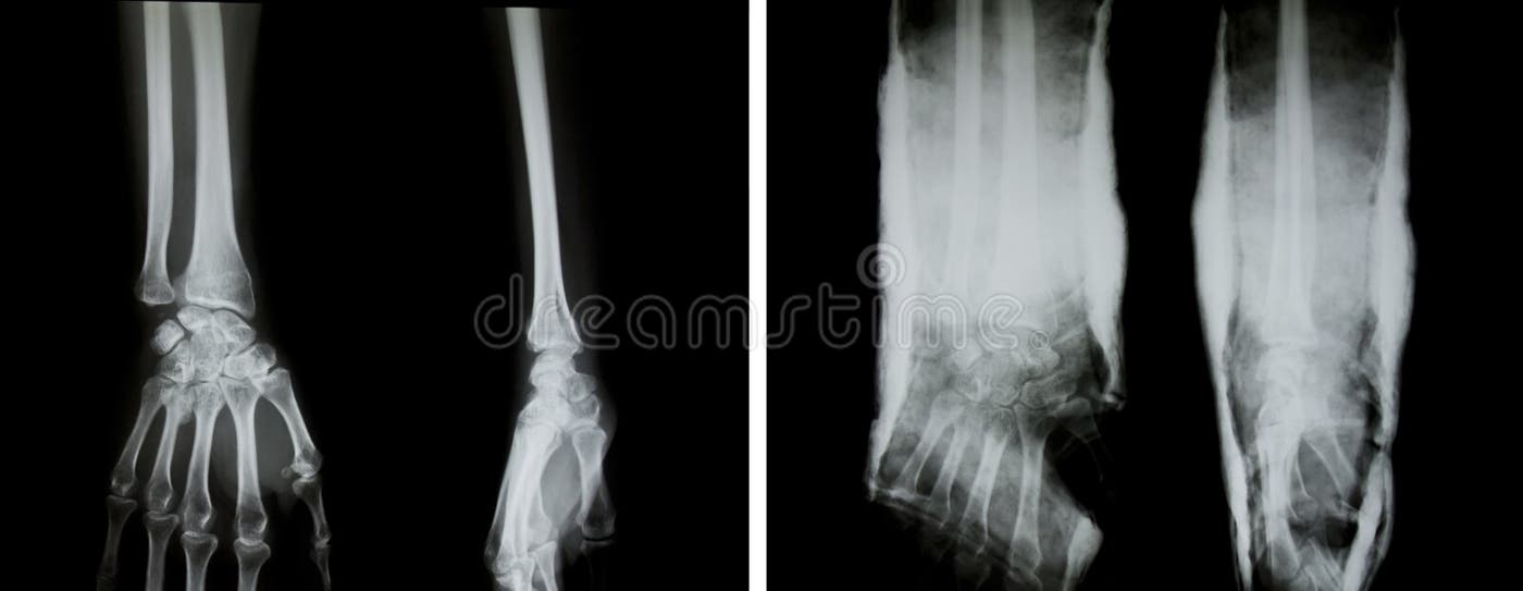X Ray Normal Arms Arms Splint Stock Photos - Free & Royalty-Free Stock ...