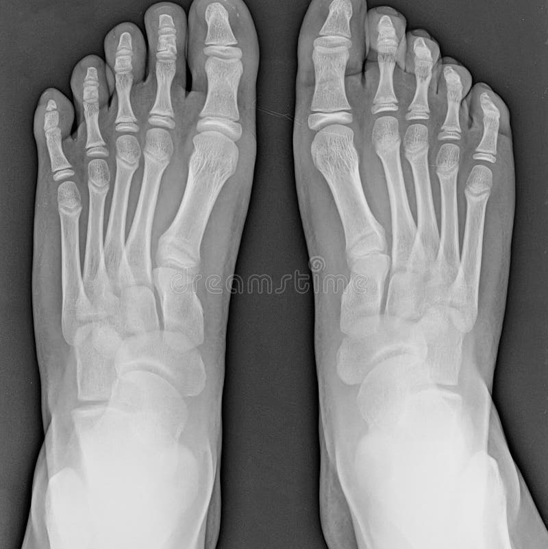 X-ray of Normal Human Feet. Top View Stock Image - Image of black ...