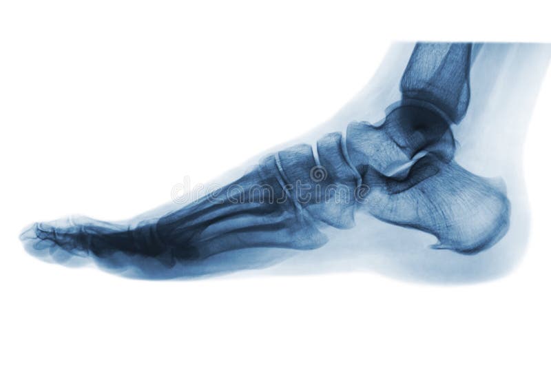 X-ray Foot Lateral : Show Normal Child S Foot Stock Photo - Image of ...