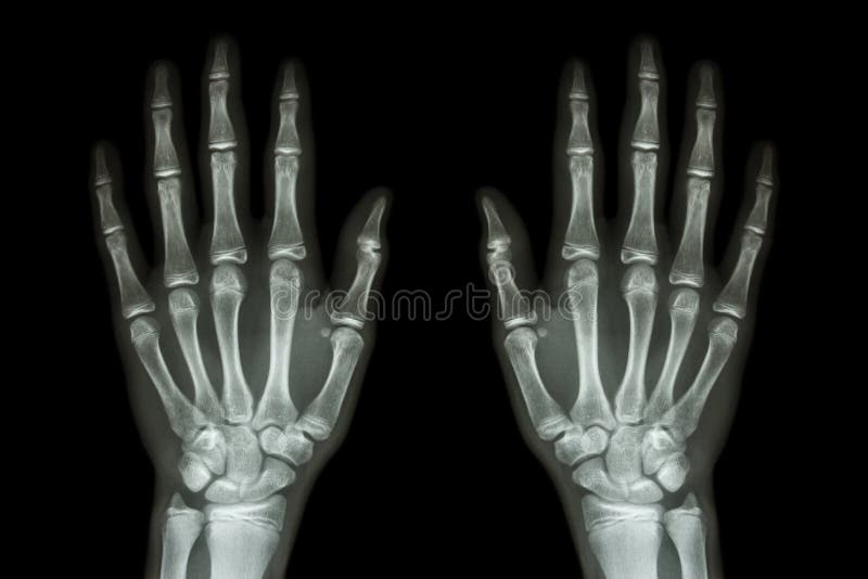 X-ray Normal Human Hands (front) Stock Image - Image of finger, pair ...