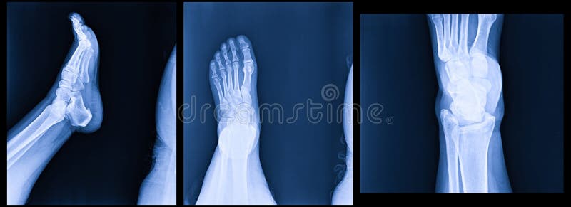 X-ray Normal Human S Foot Lateral Stock Image - Image of orthopedic ...