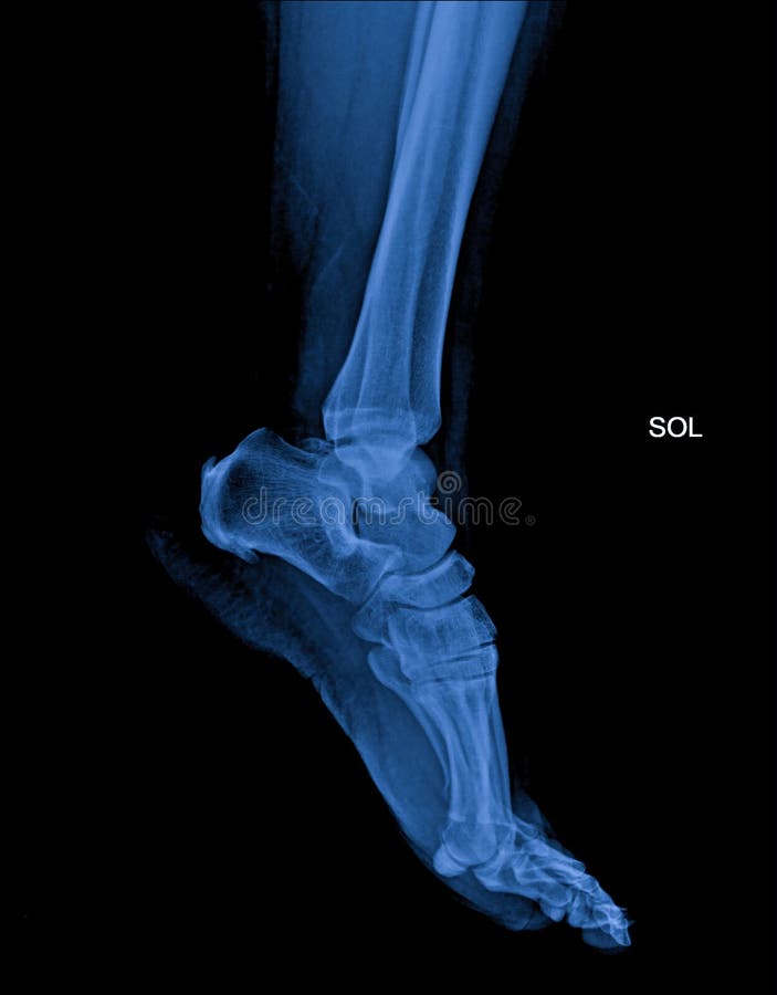 X Ray Foot Normal