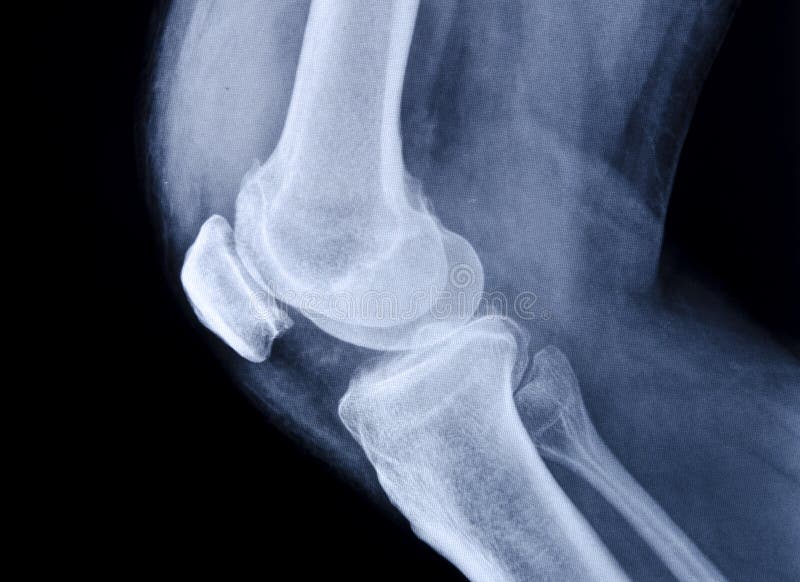 Normal Knee xray stock photo. Image of radiology, hospital - 14088732