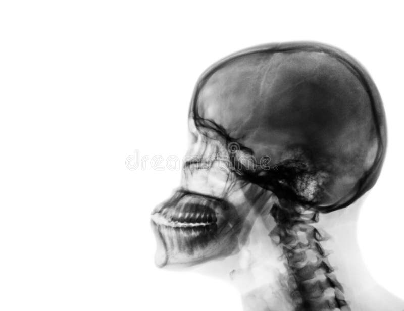 X-ray Normal Skull and Cervical Spine . Lateral View . Stock Photo ...