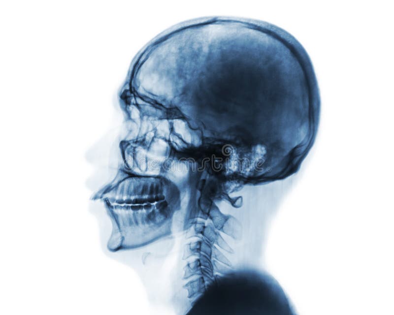 X-ray Normal Skull and Cervical Spine . Lateral View .Invert Color ...