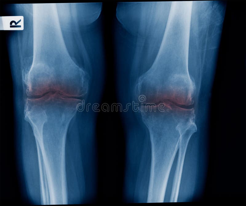 X-ray OA Knee Both Knee in Blue Tone Stock Photo - Image of orthopedic ...