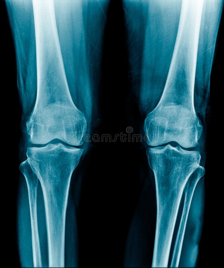 X-ray - human knee stock image. Image of health, spinal - 24206799
