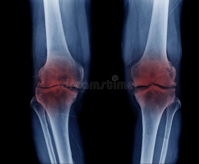 OA knee x-ray stock photo. Image of care, anatomy, joint - 123023028