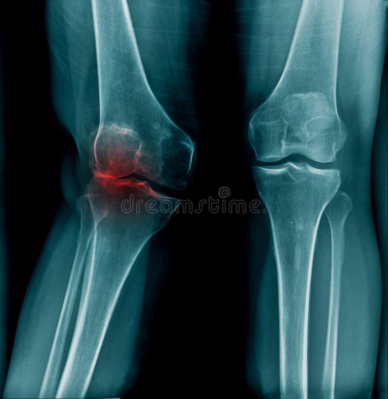 Genu valgus knee stock photo. Image of disease, black - 123022914