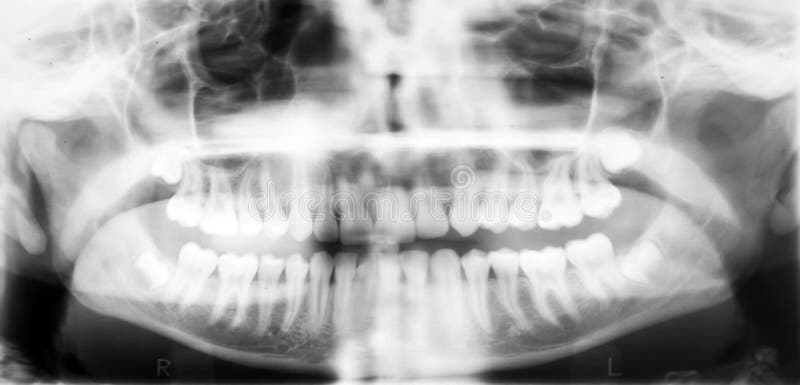 X-ray of the oral cavity. stock photo. Image of front - 13958304