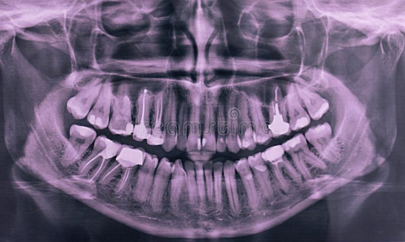 X-ray of the Oral Cavity with Teeth. Panoramic Dental X-ray ...