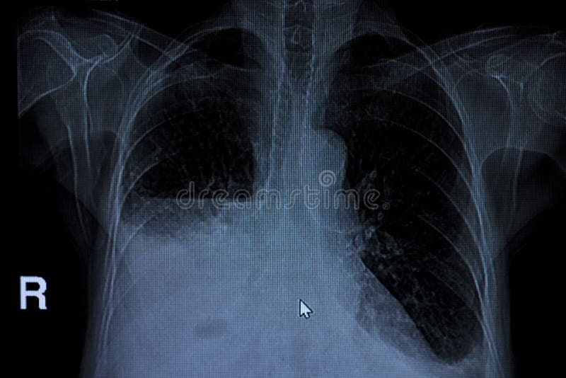 Hydropneumothorax Chest X-Ray Stock Photo - Image of disease, cancer ...