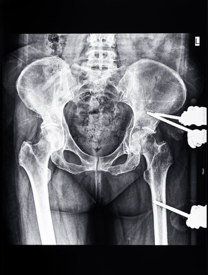 X-ray of Pelvic with External Fixation Device Stock Photo - Image of ...