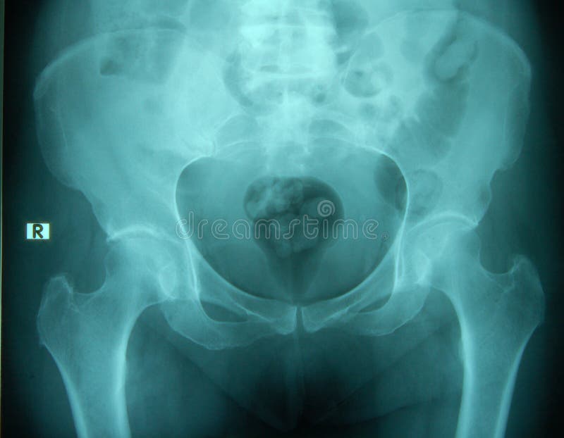 X-Ray pelvis and hips stock illustration. Illustration of pelvic - 4731652
