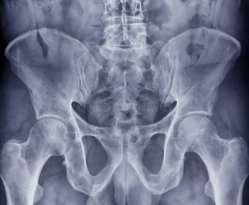 X-ray of the Pelvis of a Man Stock Photo - Image of nurse, care: 307604374